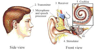Cochlear implant hearing Wellington Paraparaumu Waikanae Kapiti